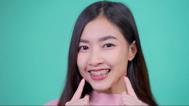 Wrap Around Retainer - BracesShop.com