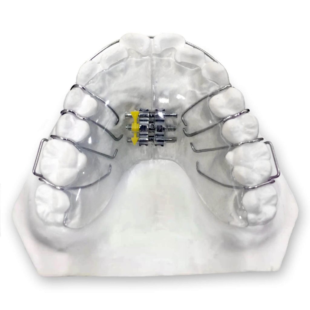 Buy Palate Expander Online | Expanders - BracesShop.com