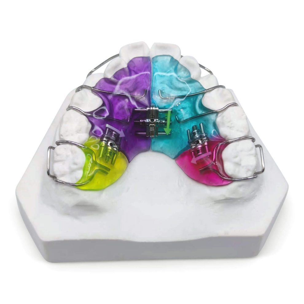 Buy Palate Expander Online | Expanders - BracesShop.com