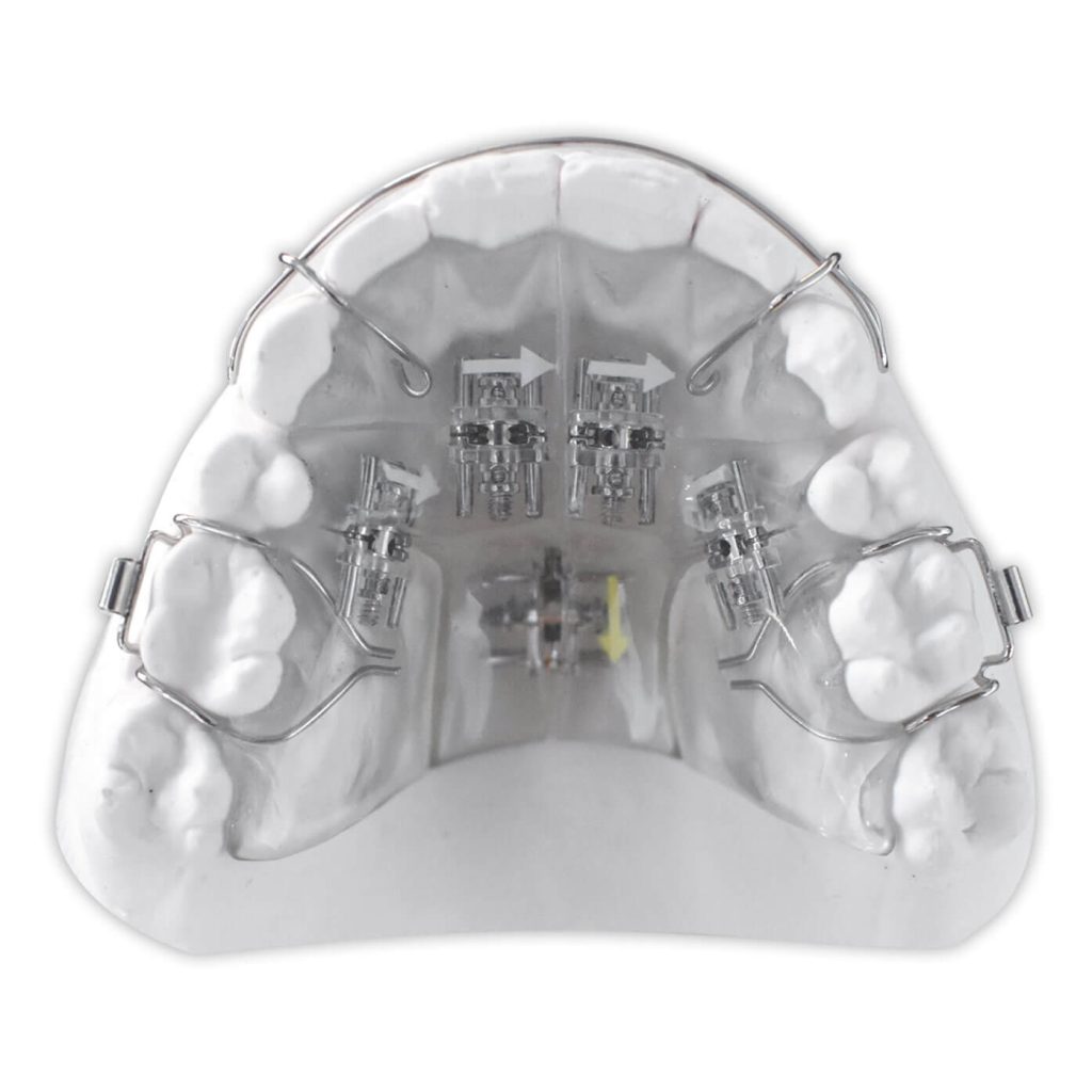 Buy Palate Expander Online | Expanders - BracesShop.com