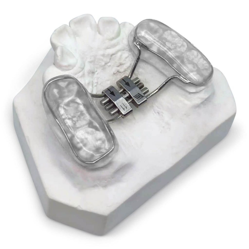 Rapid Palatal Expander (RPE) - BracesShop.com