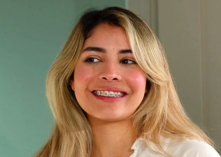 Fake Braces - Realistic Removable Braces for Photoshoots & Film ...